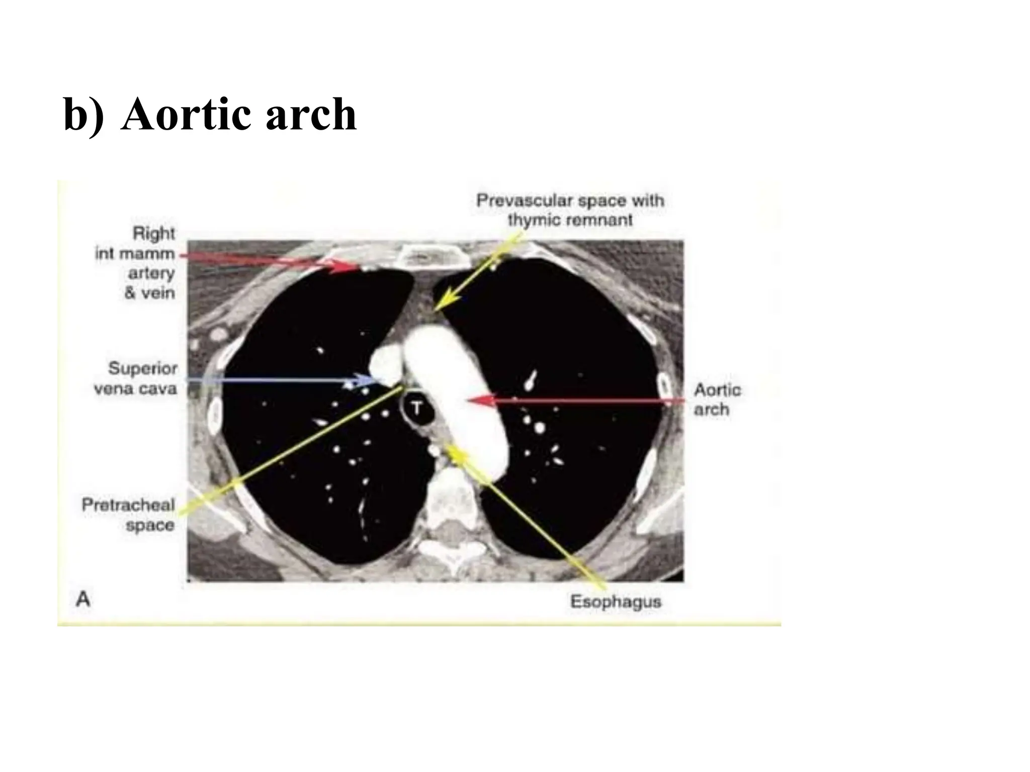 LUNG IMAGING CT SCAN with classification.pptx