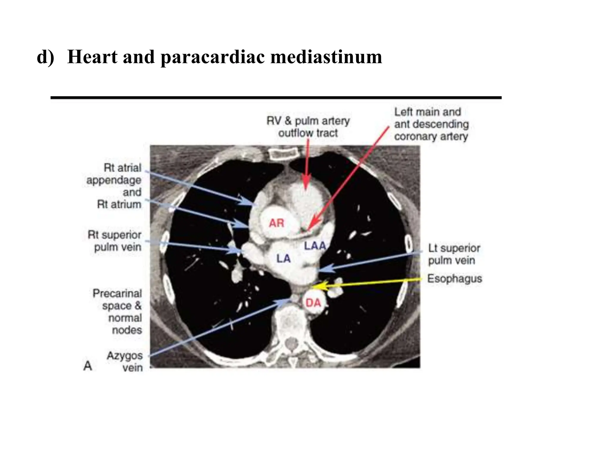 LUNG IMAGING CT SCAN with classification.pptx