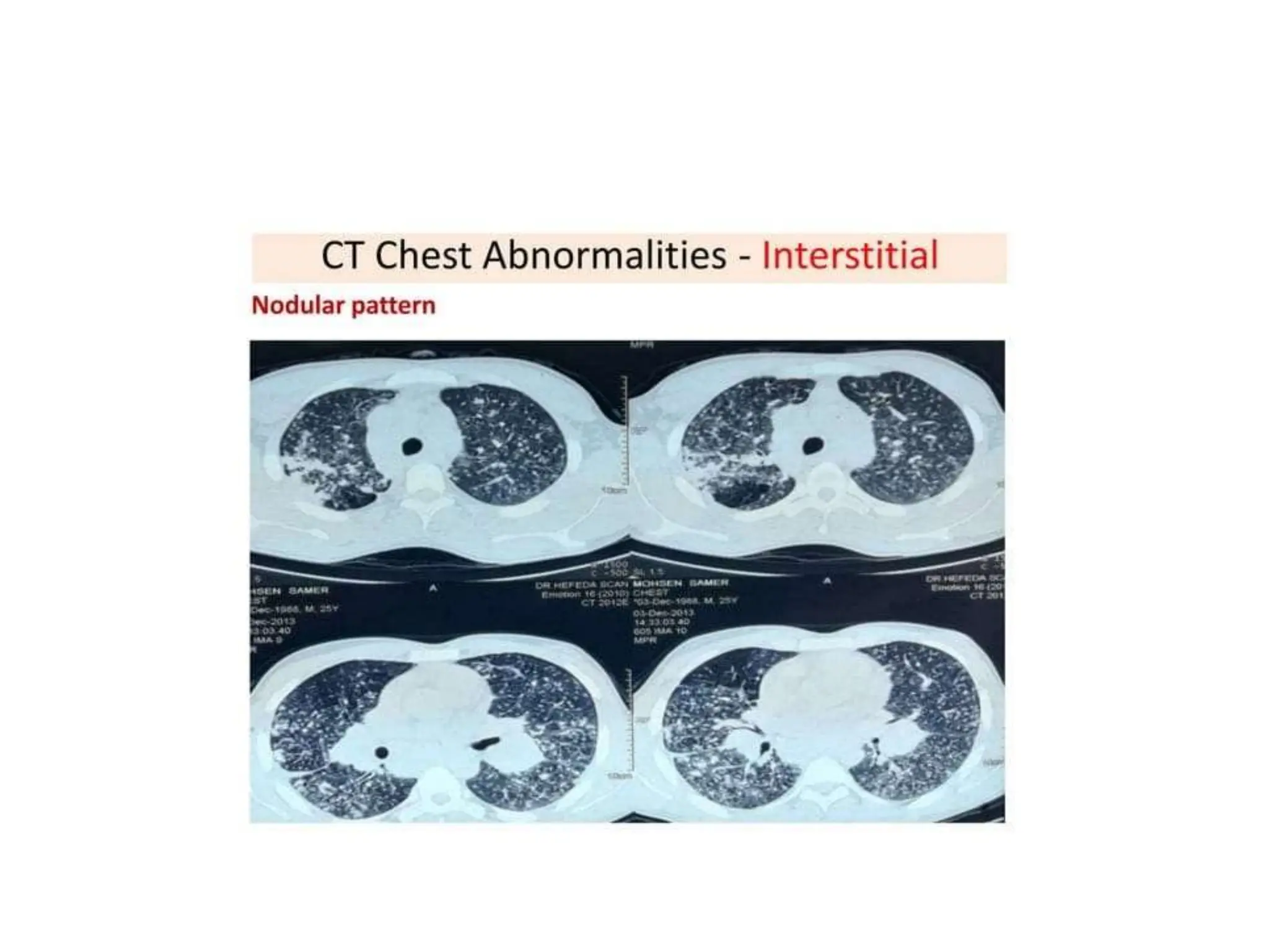 LUNG IMAGING CT SCAN with classification.pptx