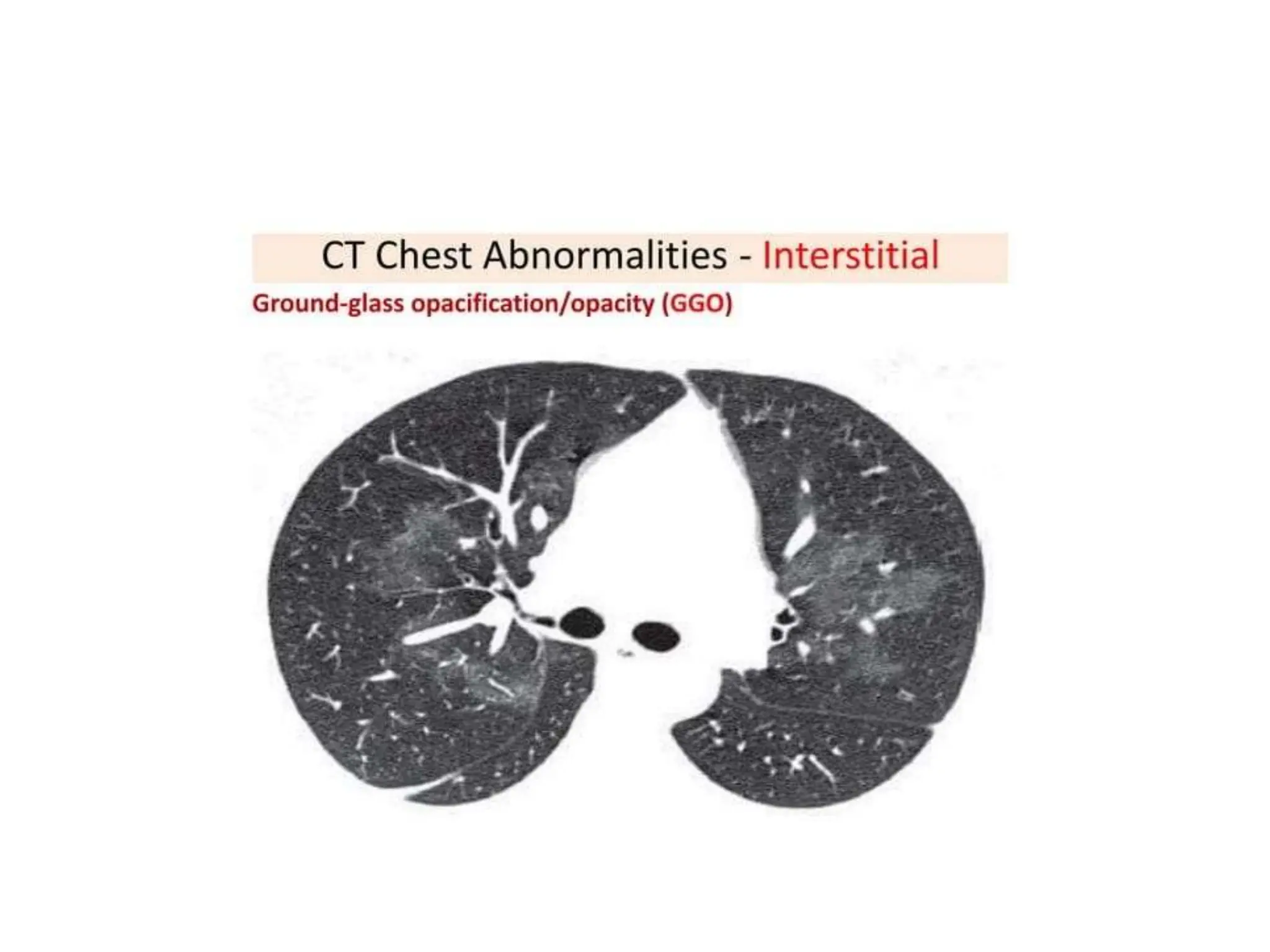 LUNG IMAGING CT SCAN with classification.pptx