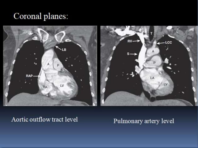 LUNG IMAGING CT SCAN with classification.pptx
