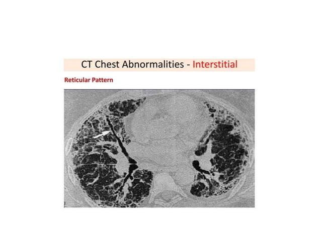 LUNG IMAGING CT SCAN with classification.pptx
