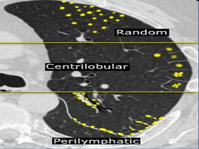 LUNG IMAGING CT SCAN with classification.pptx