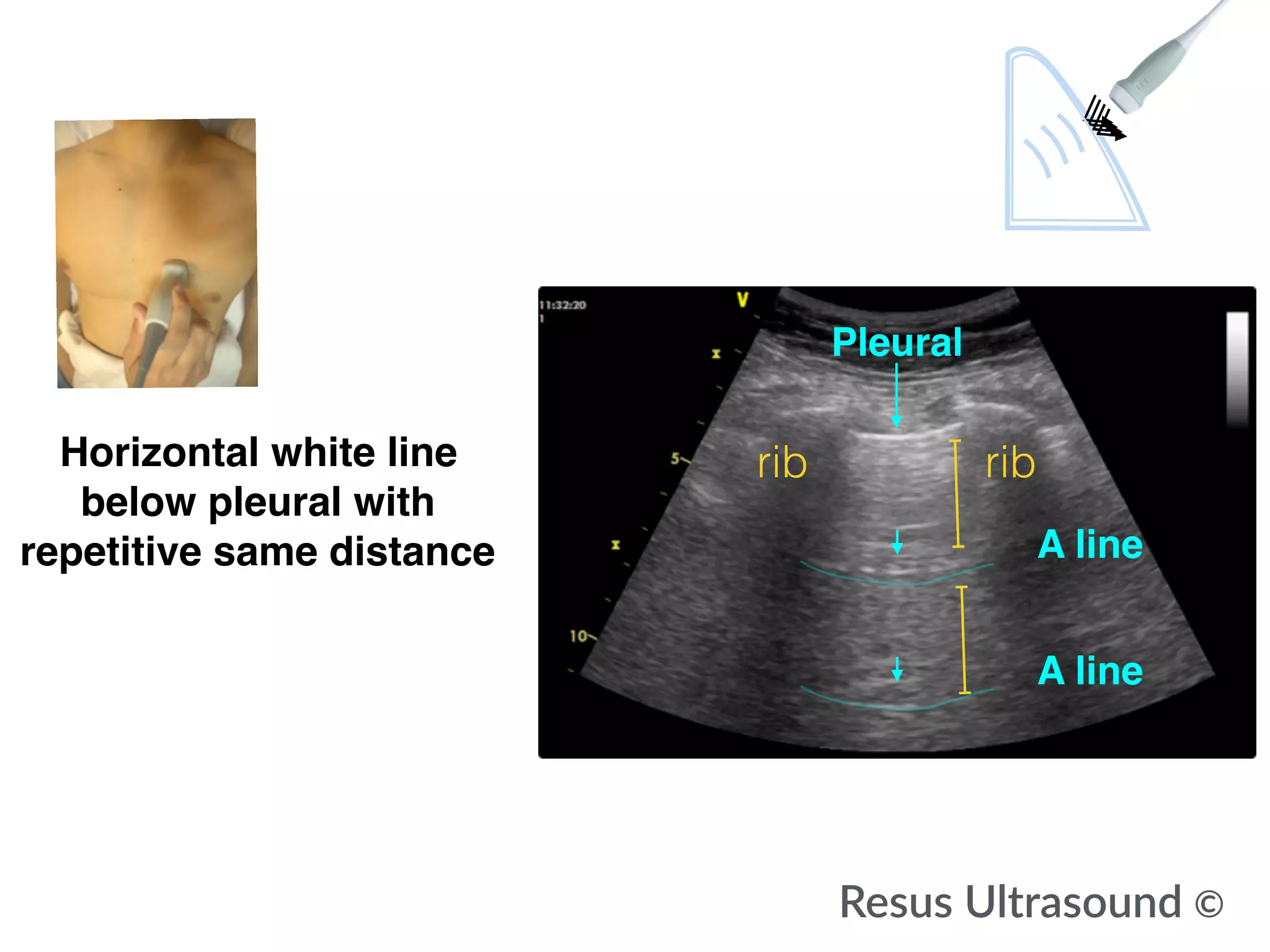 Simplified Lung Ultrasound | PDF