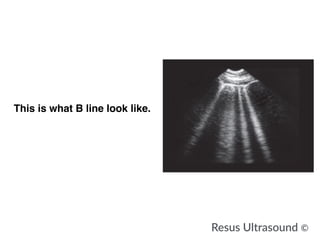 Simplified Lung Ultrasound | PDF