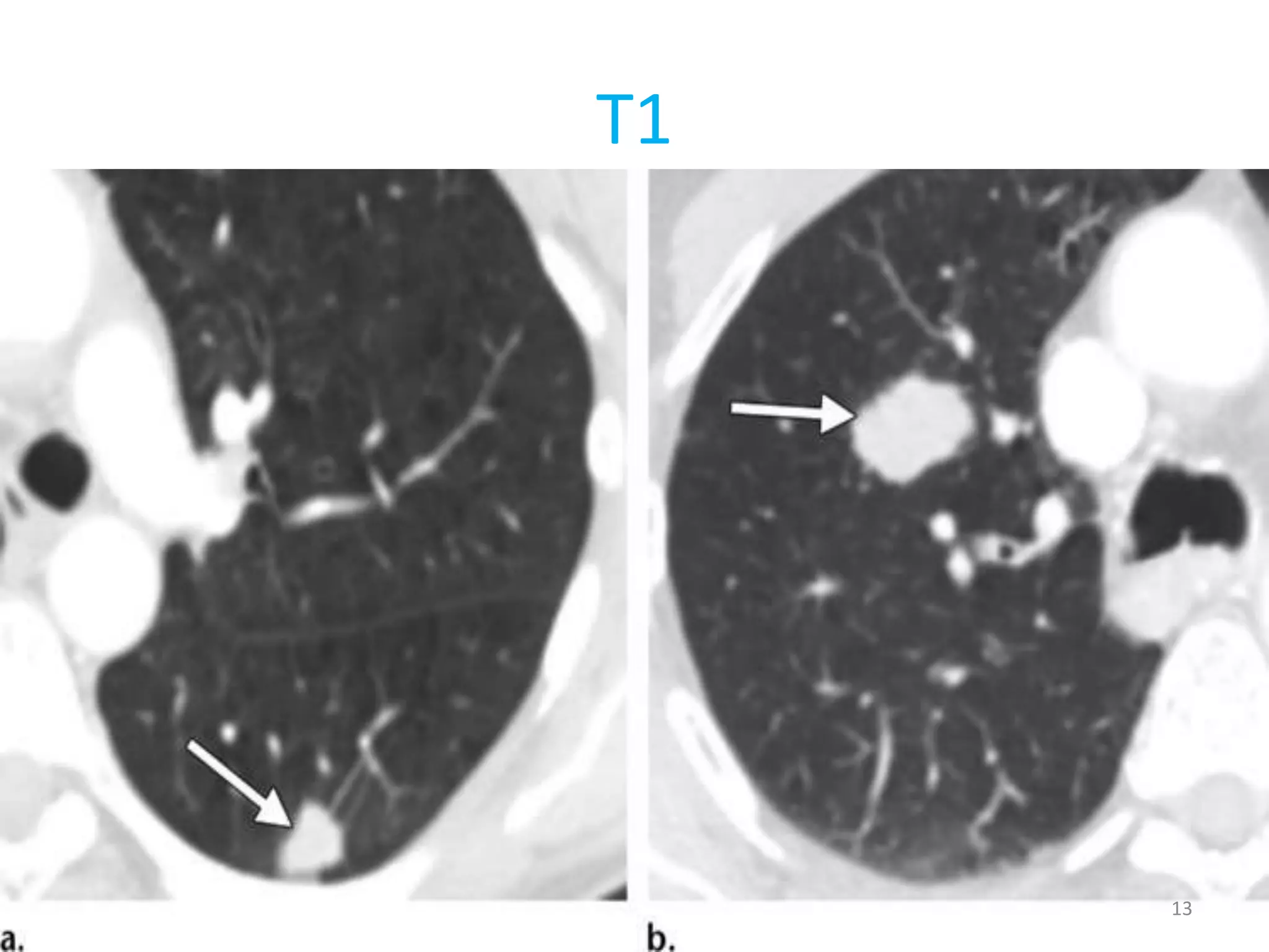 IMAGING IN LUNG CANCER | PPTX