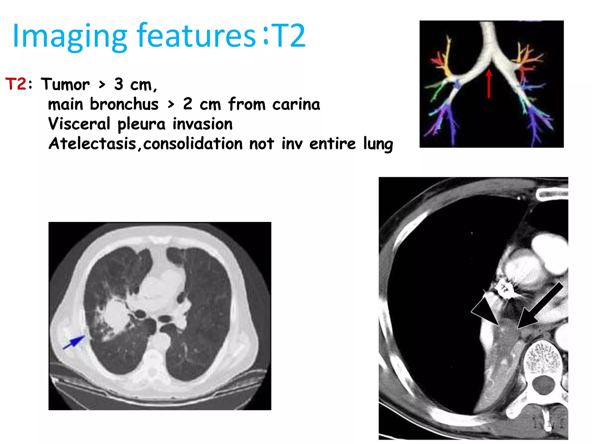 IMAGING IN LUNG CANCER | PPTX