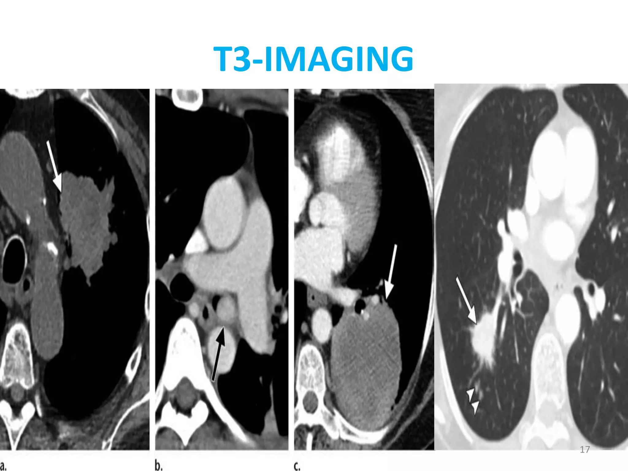 IMAGING IN LUNG CANCER | PPTX