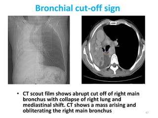IMAGING IN LUNG CANCER | PPTX