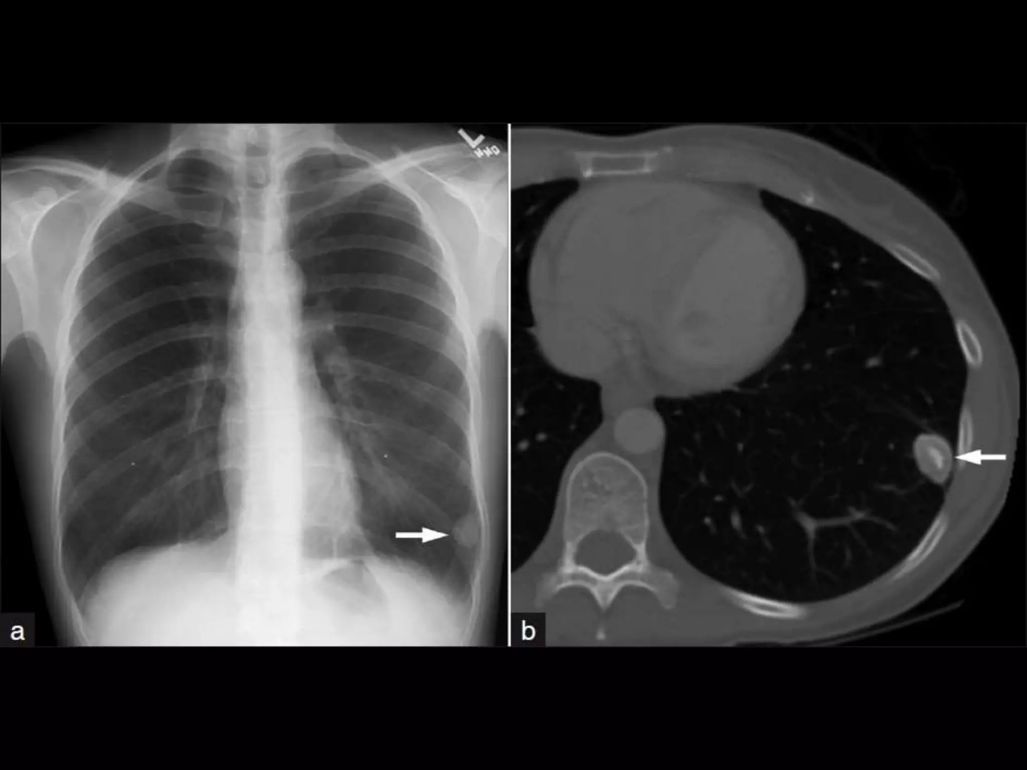 Imaging in lung masses - UG | PPTX