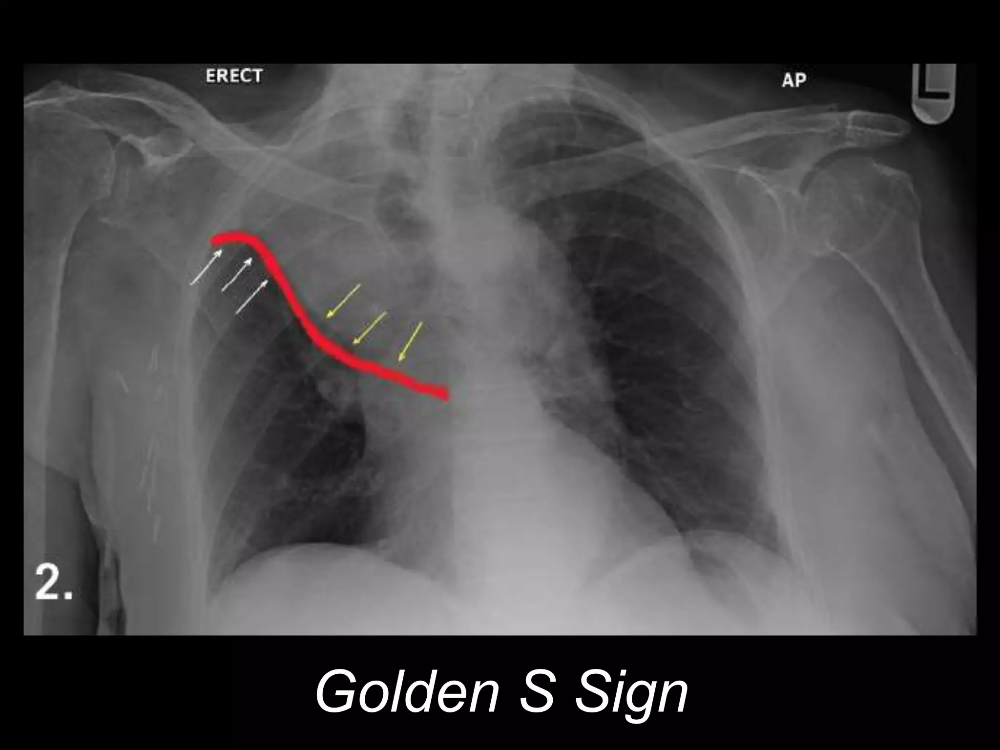 Imaging in lung masses - UG | PPTX