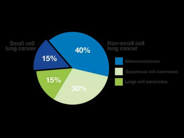 Imaging in lung masses - UG | PPT