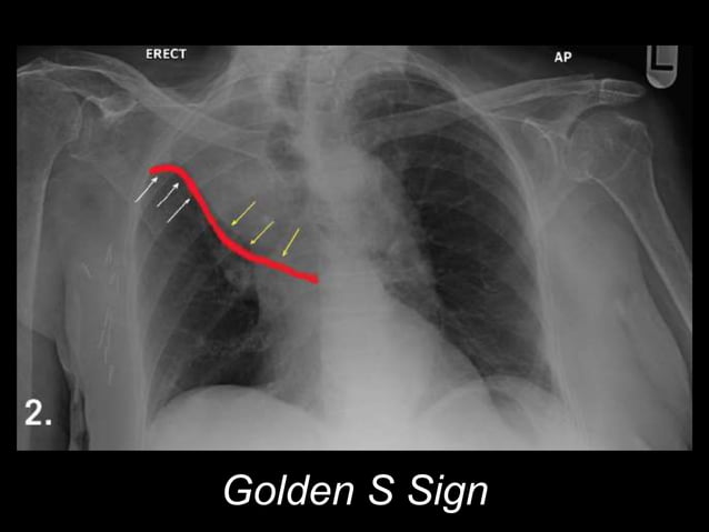 Imaging in lung masses - UG | PPT