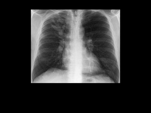 Imaging in lung masses - UG | PPT