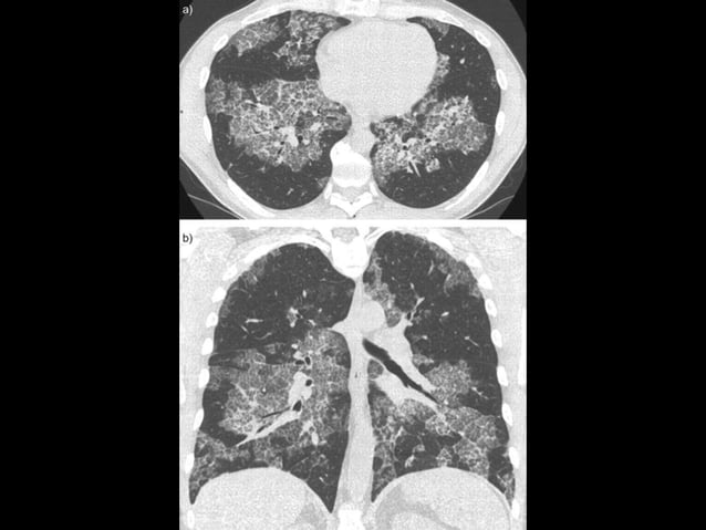 Imaging in lung masses - UG | PPT