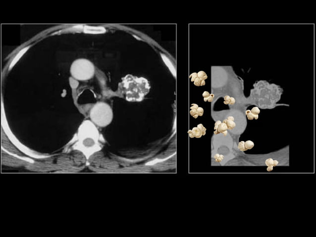 Imaging in lung masses - UG | PPT