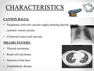 management of lung mets | PPT