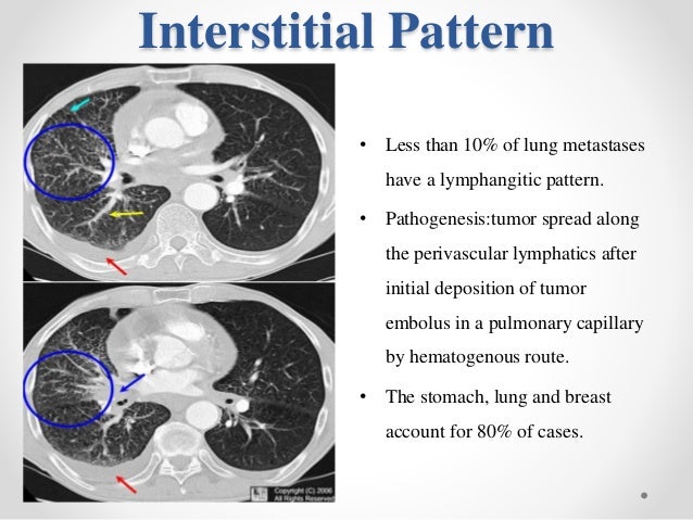 management of lung mets