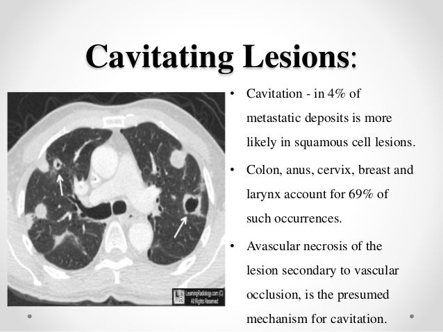 management of lung mets