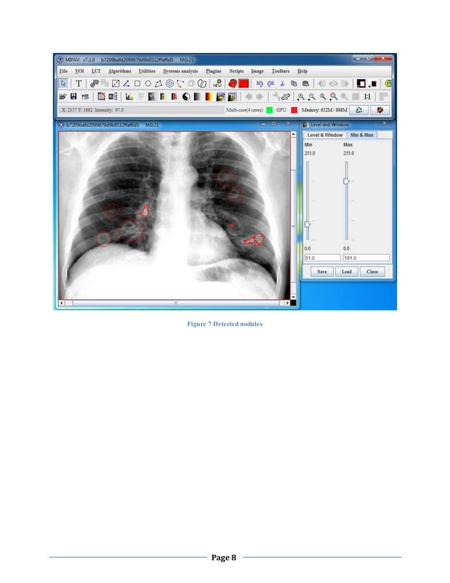 Lung Nodule Detection Pdf