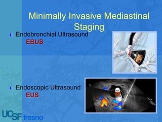 Echoendoscopic Lymph Node Staging in Lung Cancer: An endoscopic ...