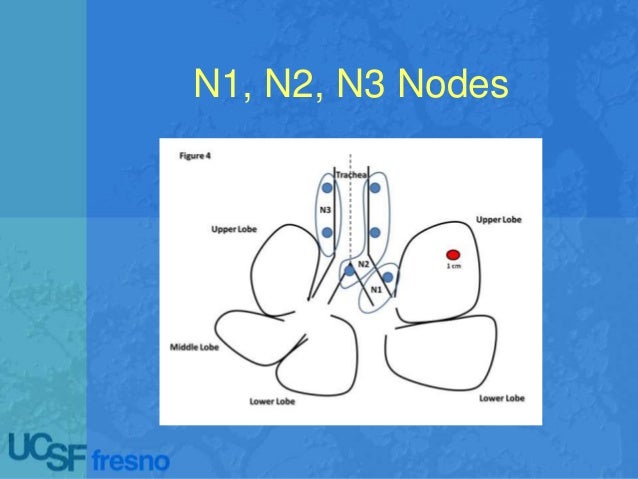 Echoendoscopic Lymph Node Staging in Lung Cancer: An endoscopic alter…