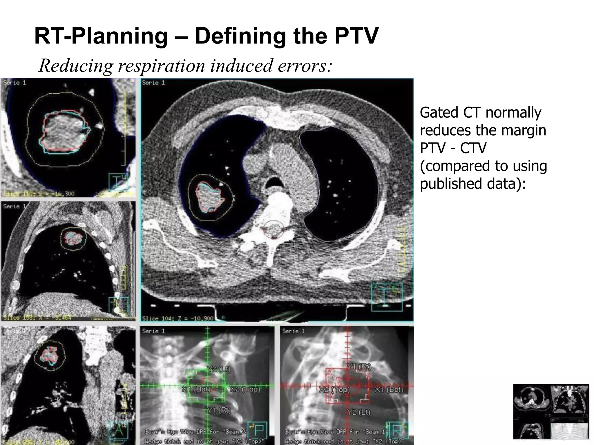 Lung plan evaluation | PDF