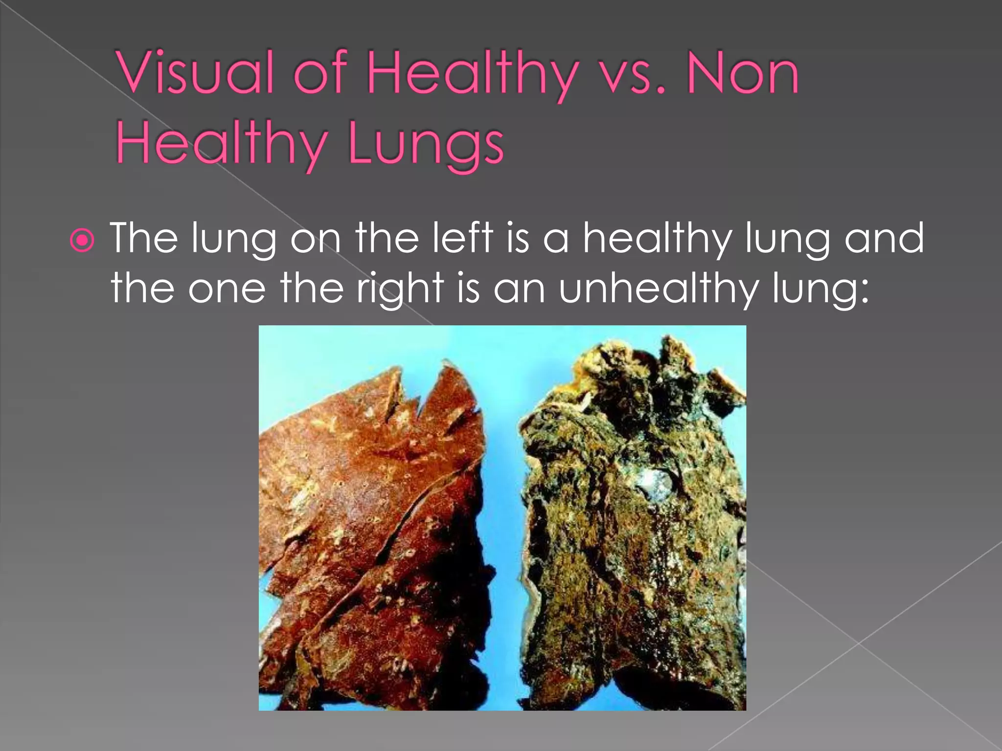 Lung presentation 2 | PPTX