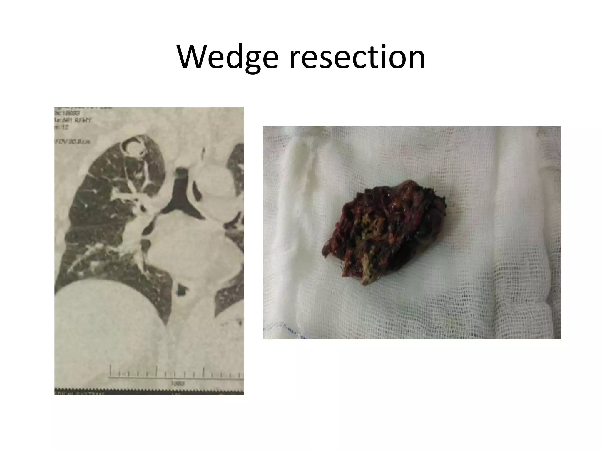 Lung resections | PPTX