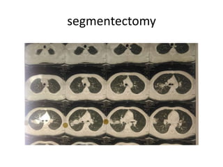 Lung resections | PPTX