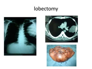 Lung resections | PPTX