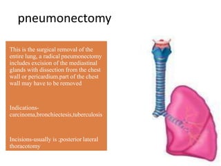 Lung resections | PPTX