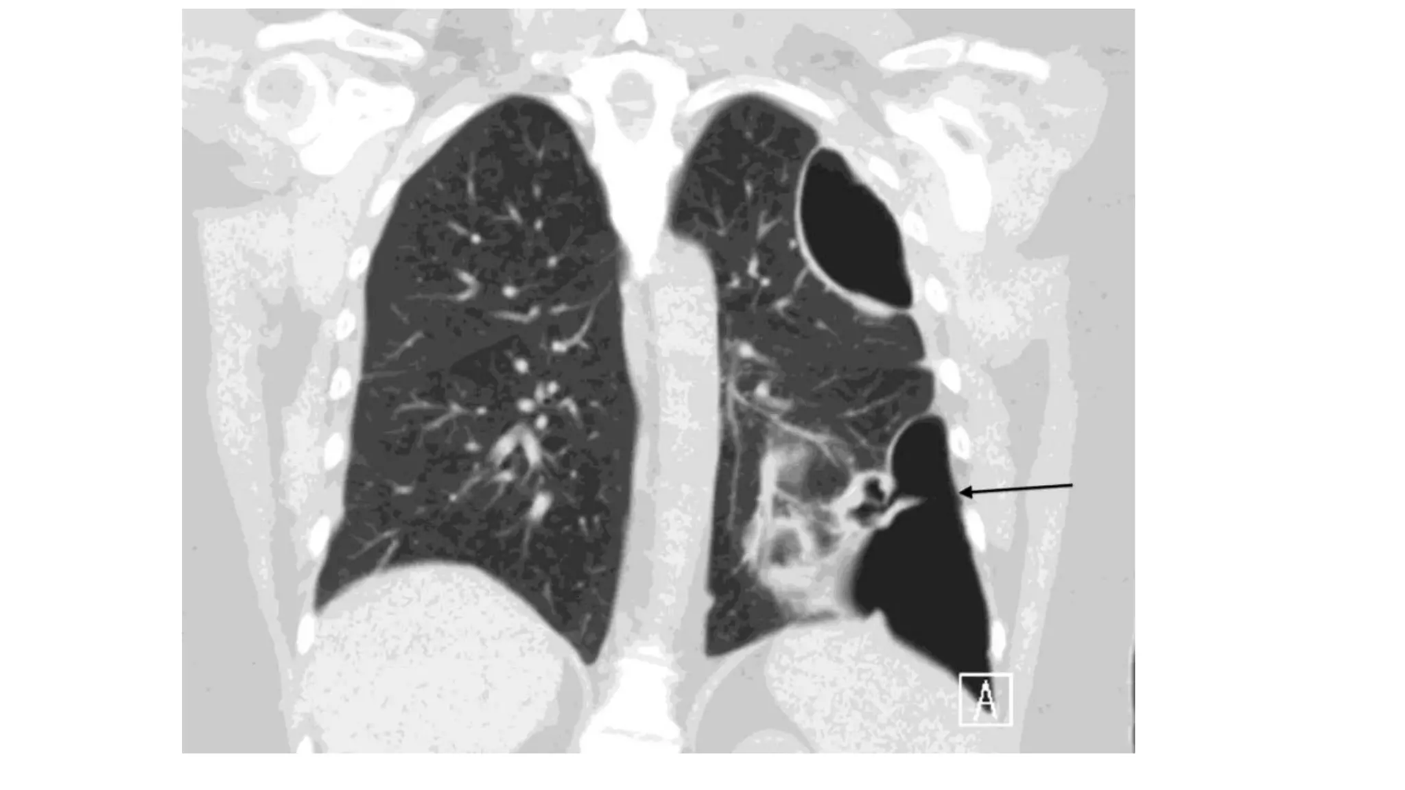 Lungs abscess | PPTX