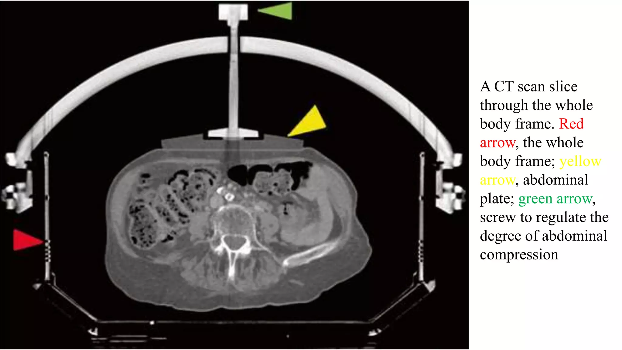 Lung sbrt ppt | PPTX