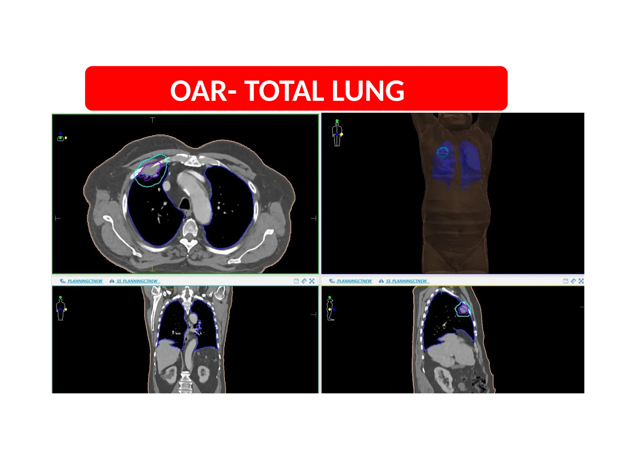 PERIPHERAL LESION LUNG SBRT ROSE CASE PPT | PPTX