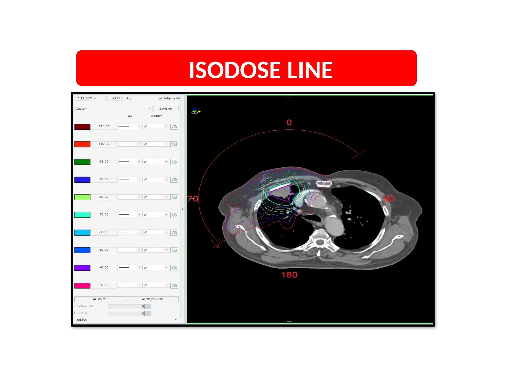 PERIPHERAL LESION LUNG SBRT ROSE CASE PPT | PPTX
