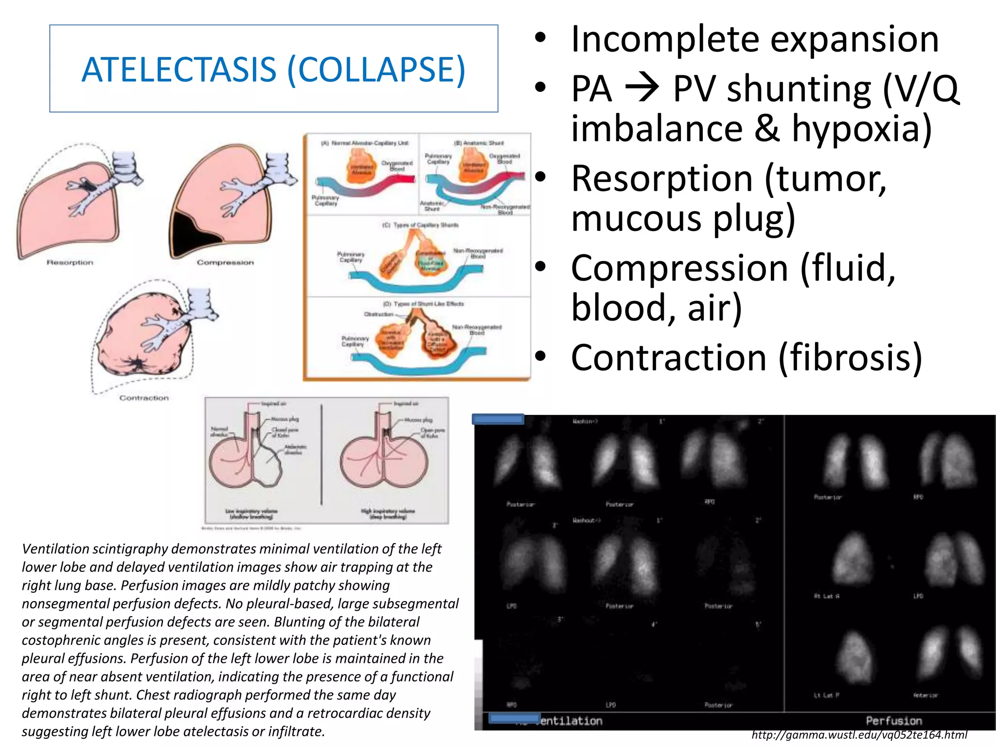 Lung scintigraphy in various lung pathologies | PPTX