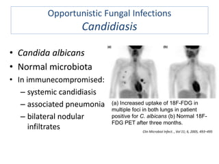 Lung scintigraphy in various lung pathologies | PPTX