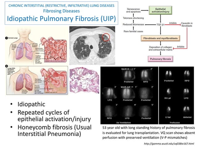 Lung scintigraphy in various lung pathologies