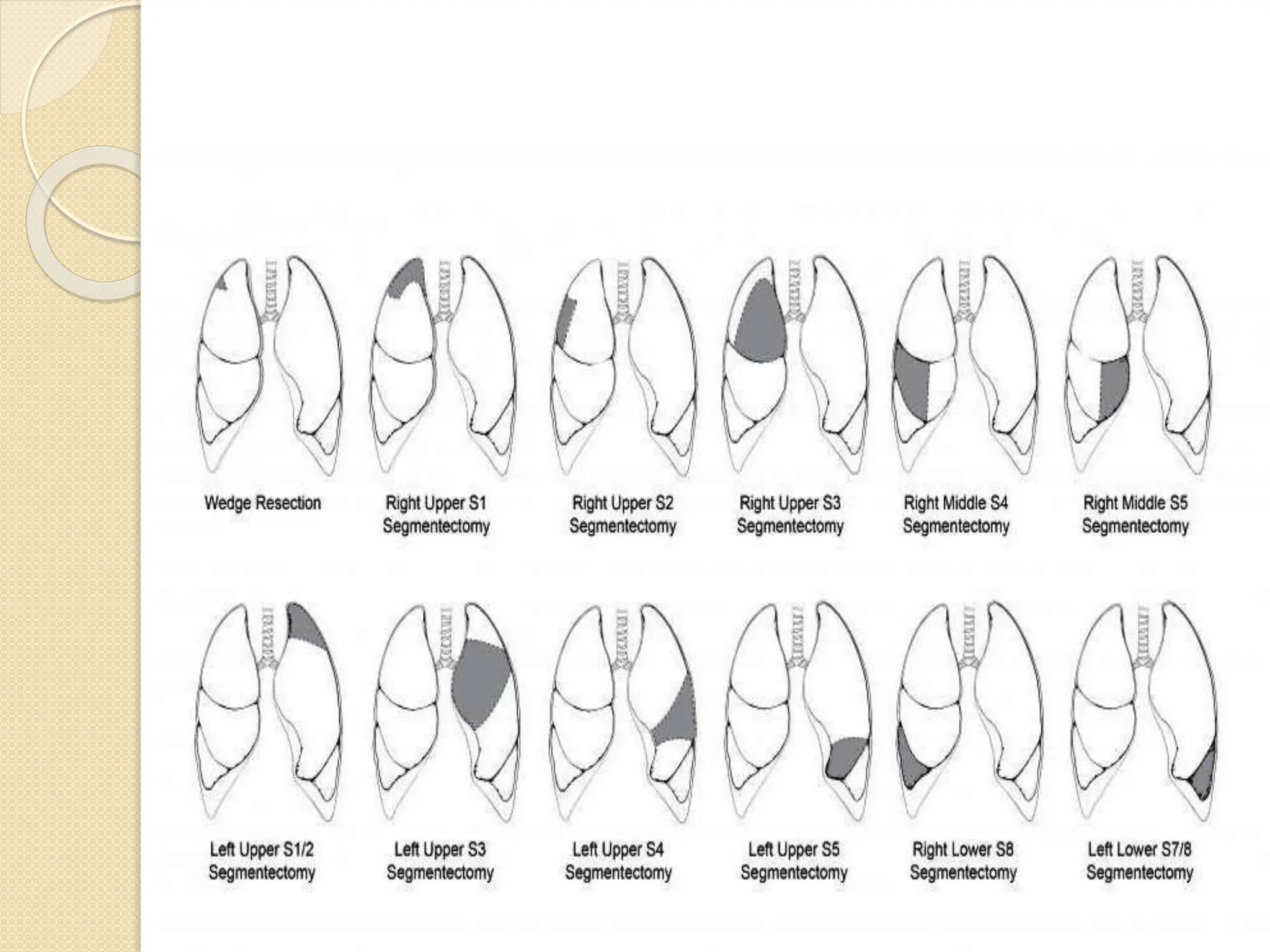 LUNG SURGERIES BY DR HEMANG JANI MPT CARDIO.pptx