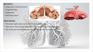 LUNG SURGERY AND IT'S REASONS..pdf