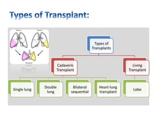 Lung Transplantation | PPTX