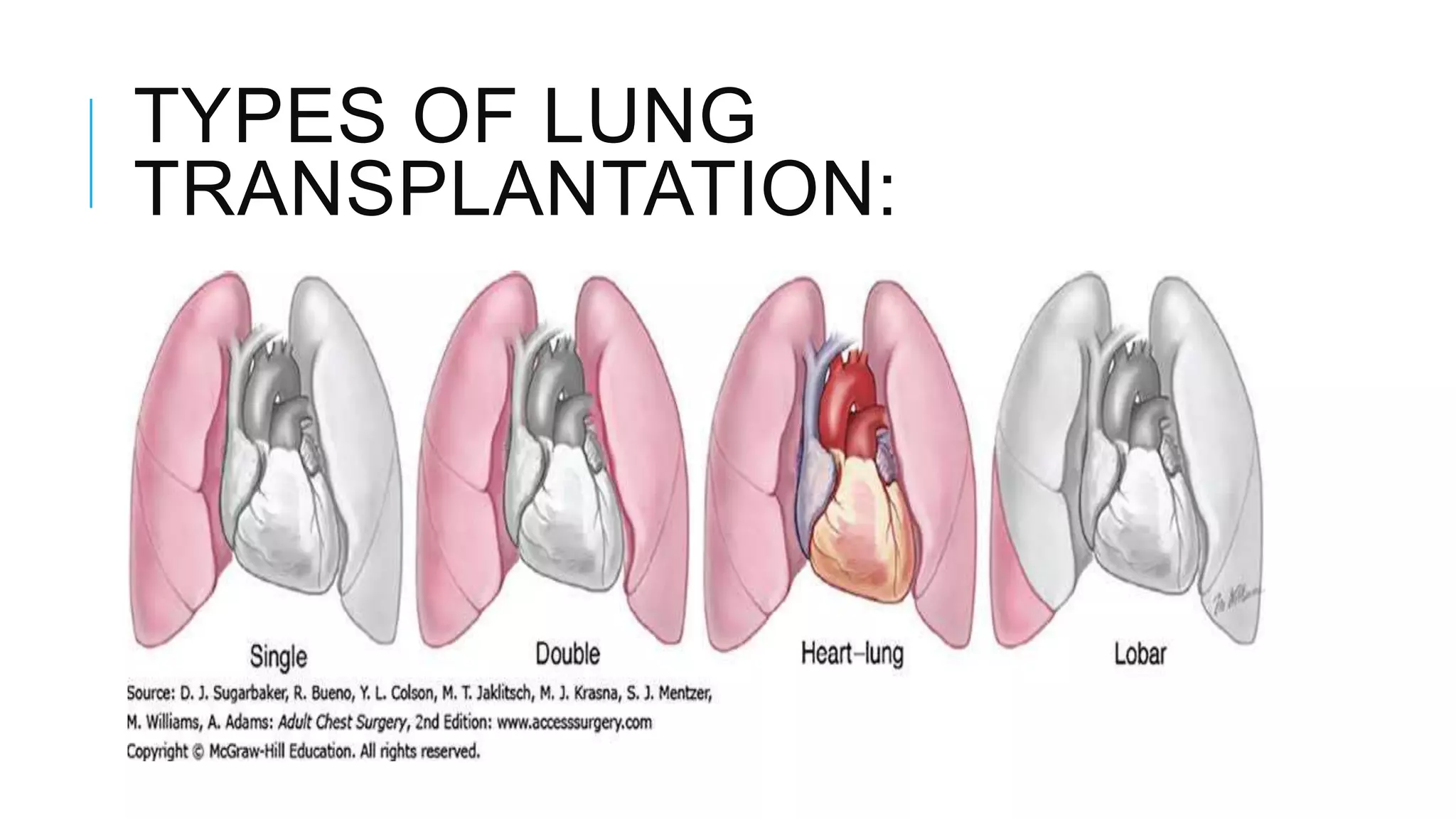 Lung transplantation and role of physiotherapy | PPTX