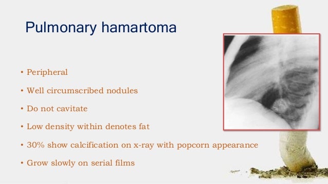 Lung tumor radiology