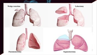 LUNG TUMORS AND ITS CLASSIFICATIONS.pdf