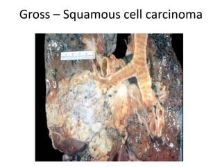 Squamous Cell Carcinoma Lung Gross