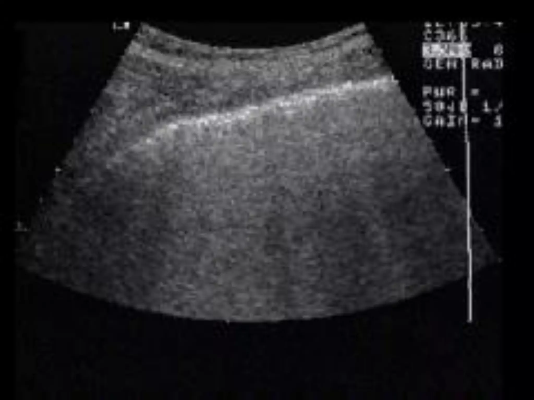 Lung Ultrasound | PDF