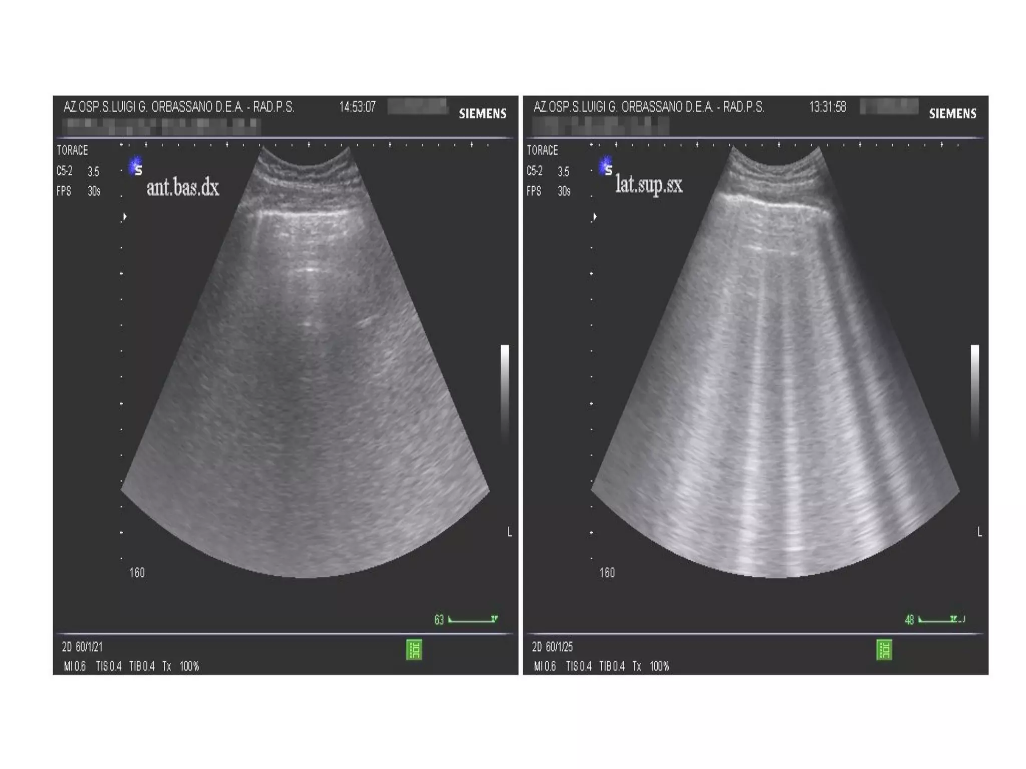 Lung Ultrasound | PDF