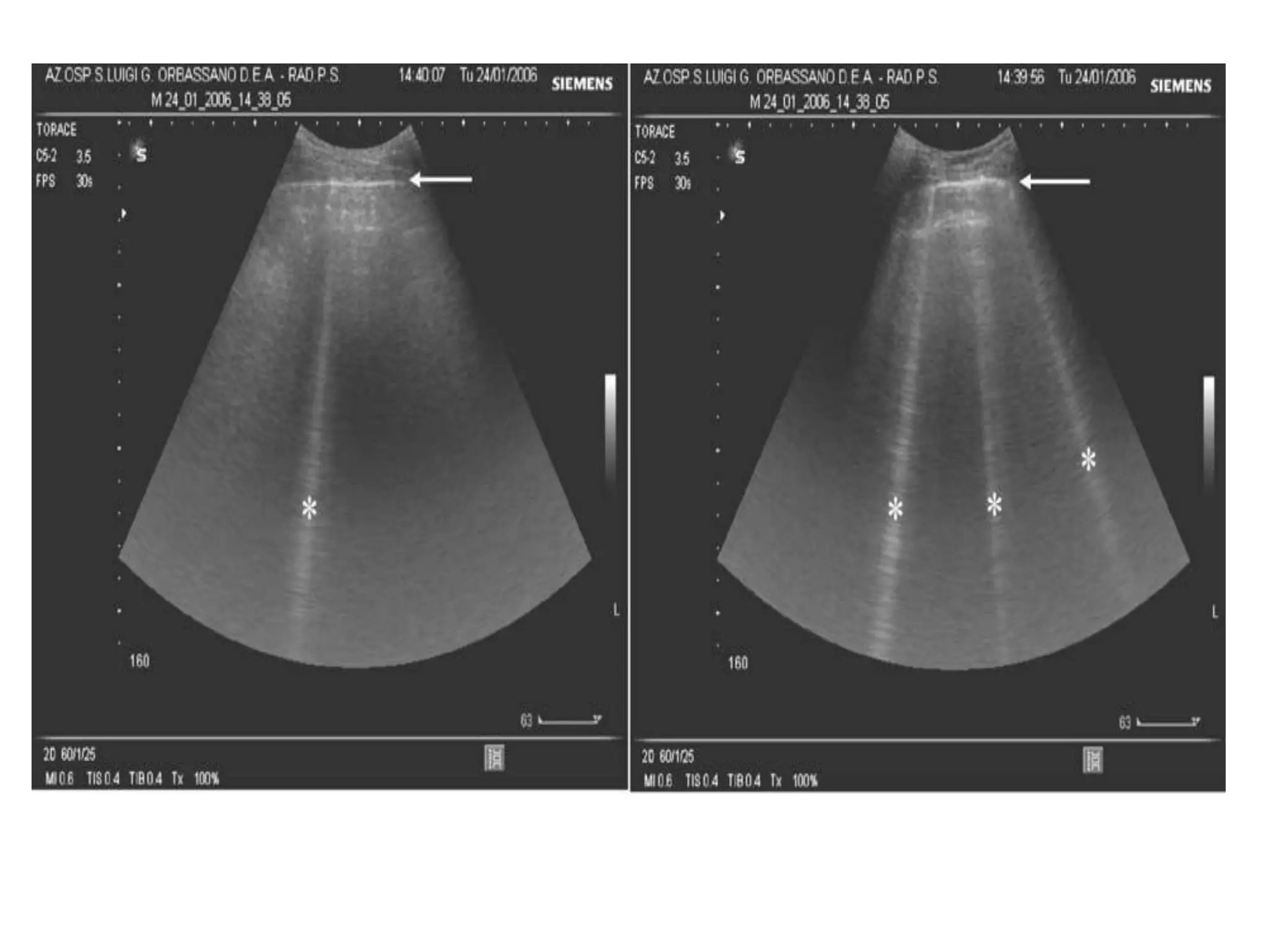 Lung Ultrasound | PDF