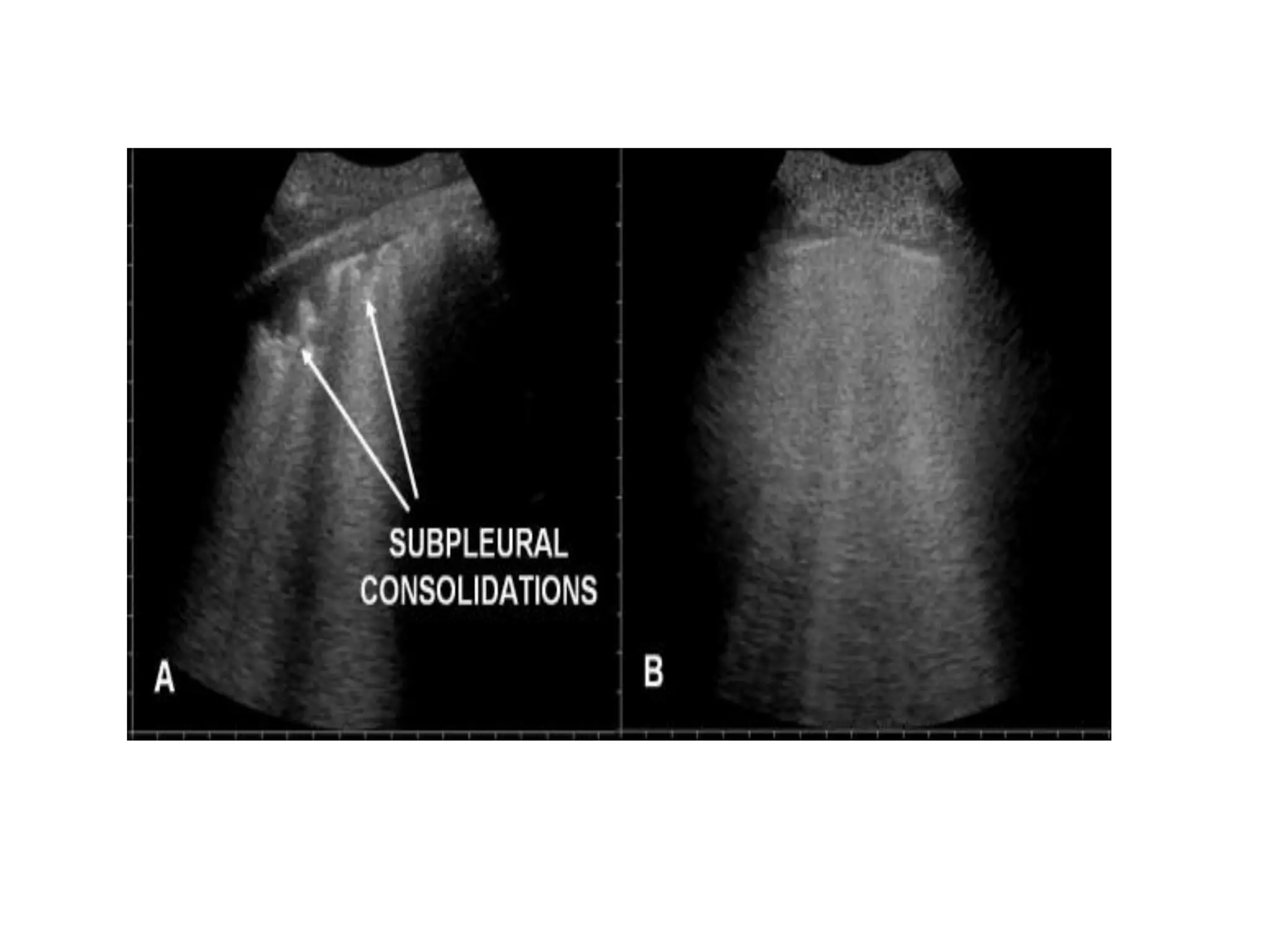 Lung Ultrasound | PDF